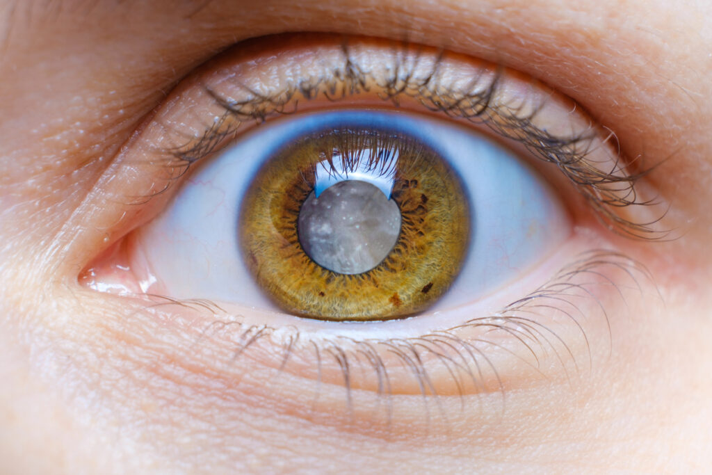 Why Do Cataracts Develop? | Merkley Eye Surgery Center
